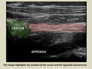 Presentation1.pptx, ultrasound examination of the appendix. | PPTX