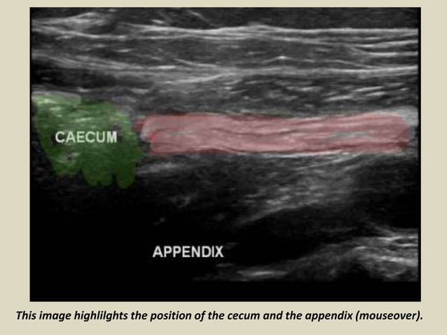 Presentation1.pptx, ultrasound examination of the appendix. | PPTX