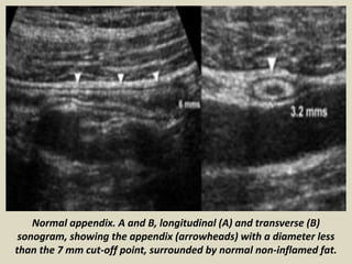 Presentation1.pptx, ultrasound examination of the appendix. | PPT
