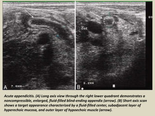 Presentation1.pptx, ultrasound examination of the appendix. | PPT