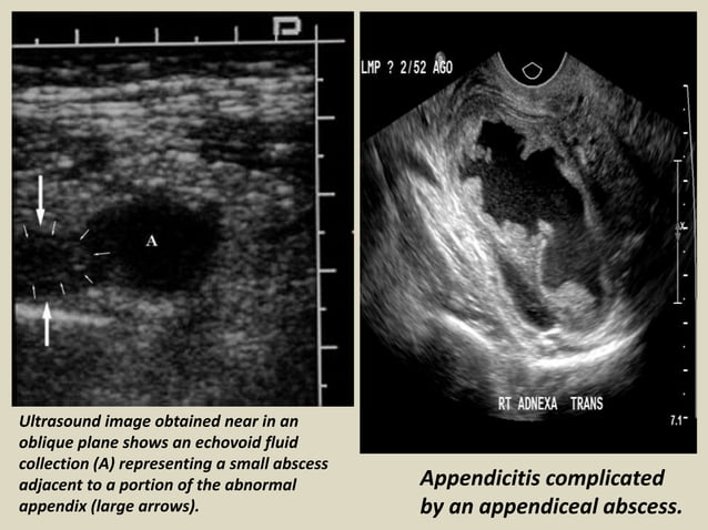 Presentation1.pptx, ultrasound examination of the appendix. | PPT