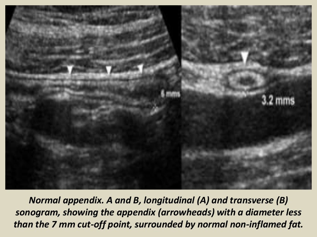 Presentation1.pptx, ultrasound examination of the appendix.