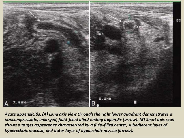 Presentation1.pptx, ultrasound examination of the appendix.