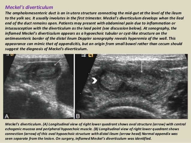 Presentation1.pptx, ultrasound examination of the appendix.