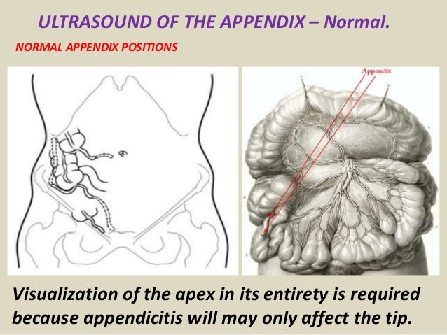 Presentation1.pptx, ultrasound examination of the appendix.