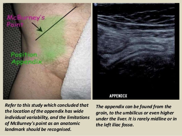Presentation1.pptx, ultrasound examination of the appendix.