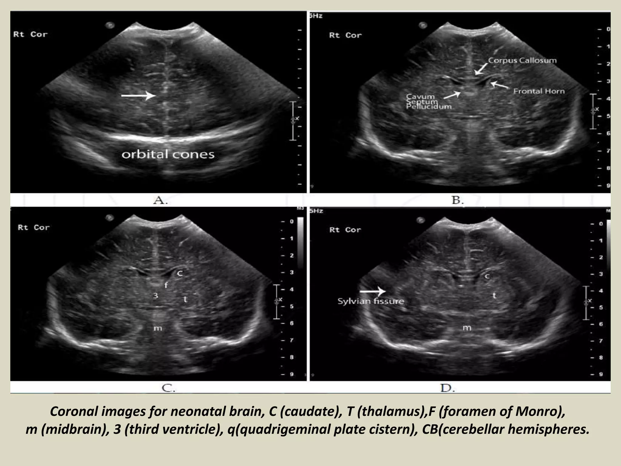 Presentation1.pptx, ultrasound examination of the neonatal head. | PPTX