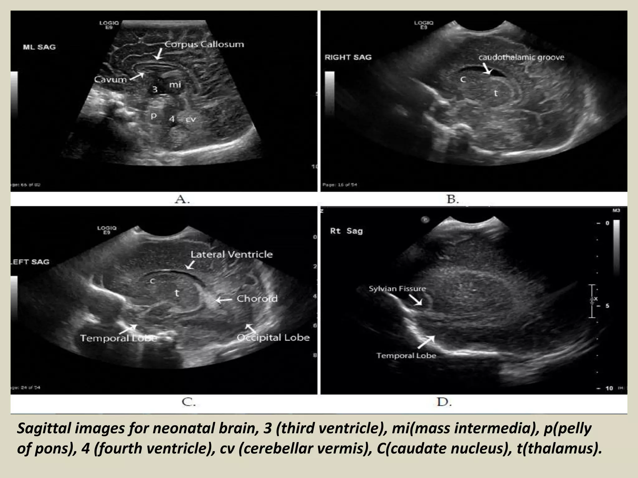 Presentation1.pptx, ultrasound examination of the neonatal head. | PPTX