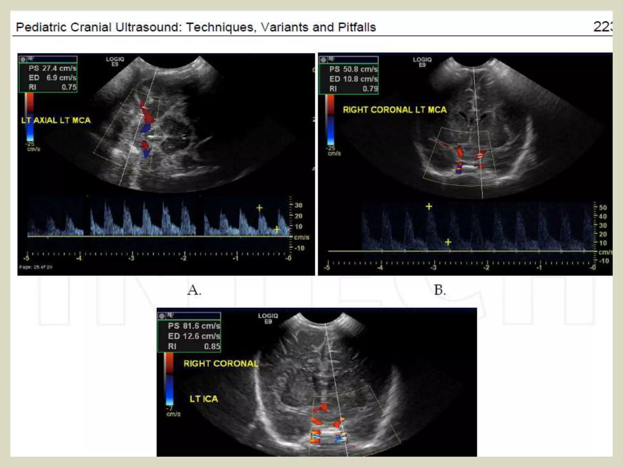 Presentation1.pptx, ultrasound examination of the neonatal head. | PPTX