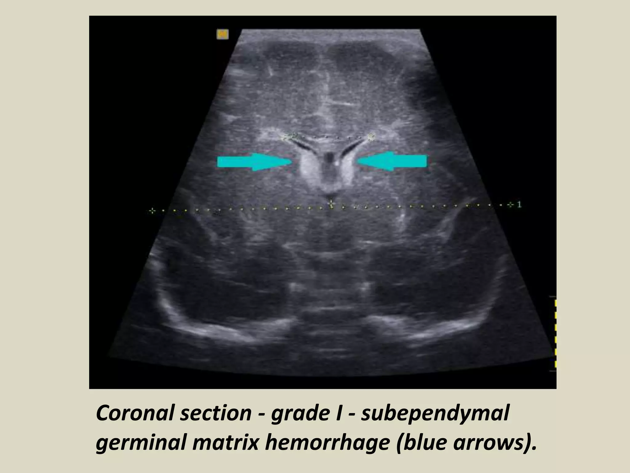 Presentation1.pptx, ultrasound examination of the neonatal head. | PPTX