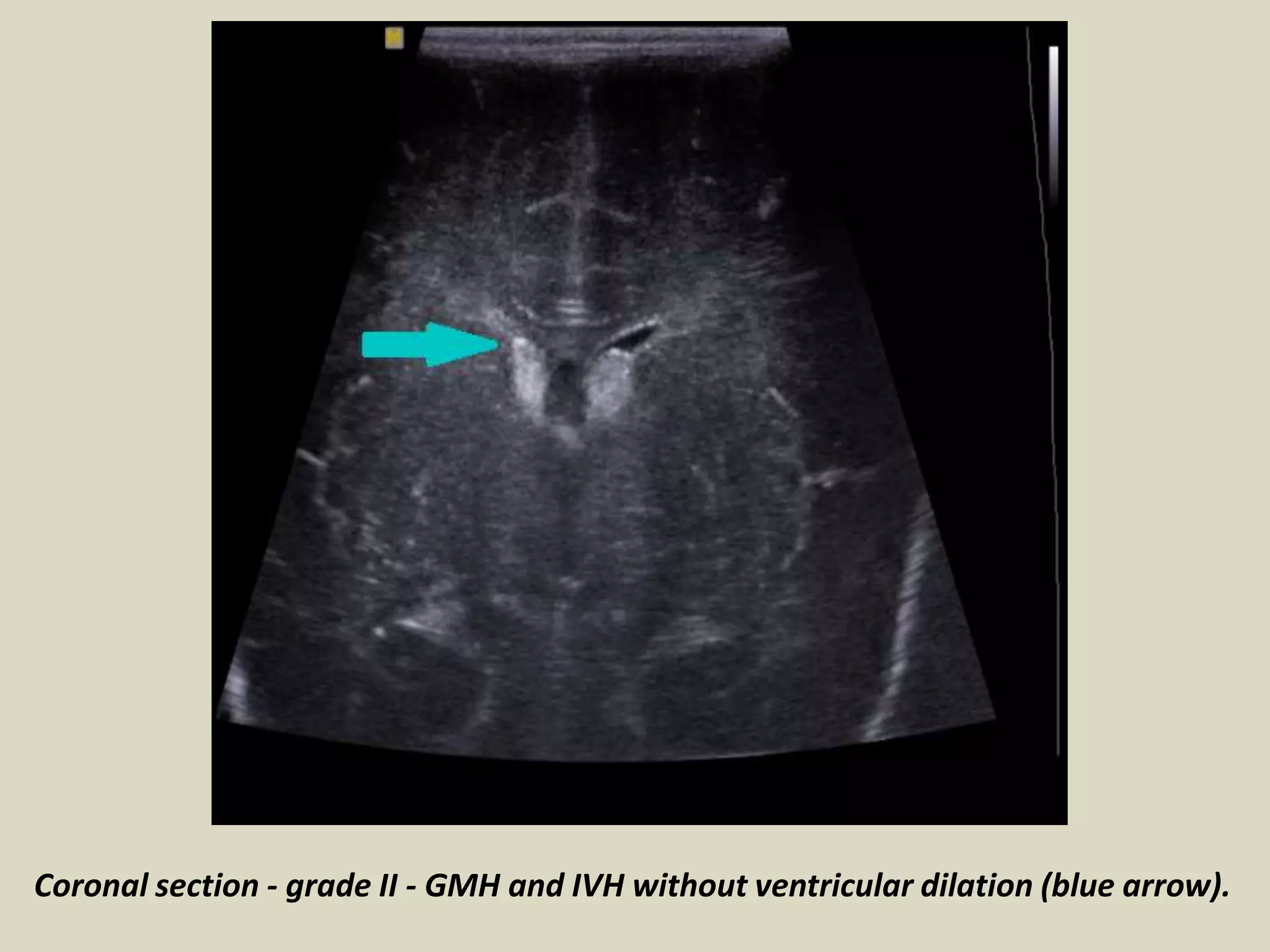 Presentation1.pptx, ultrasound examination of the neonatal head. | PPTX