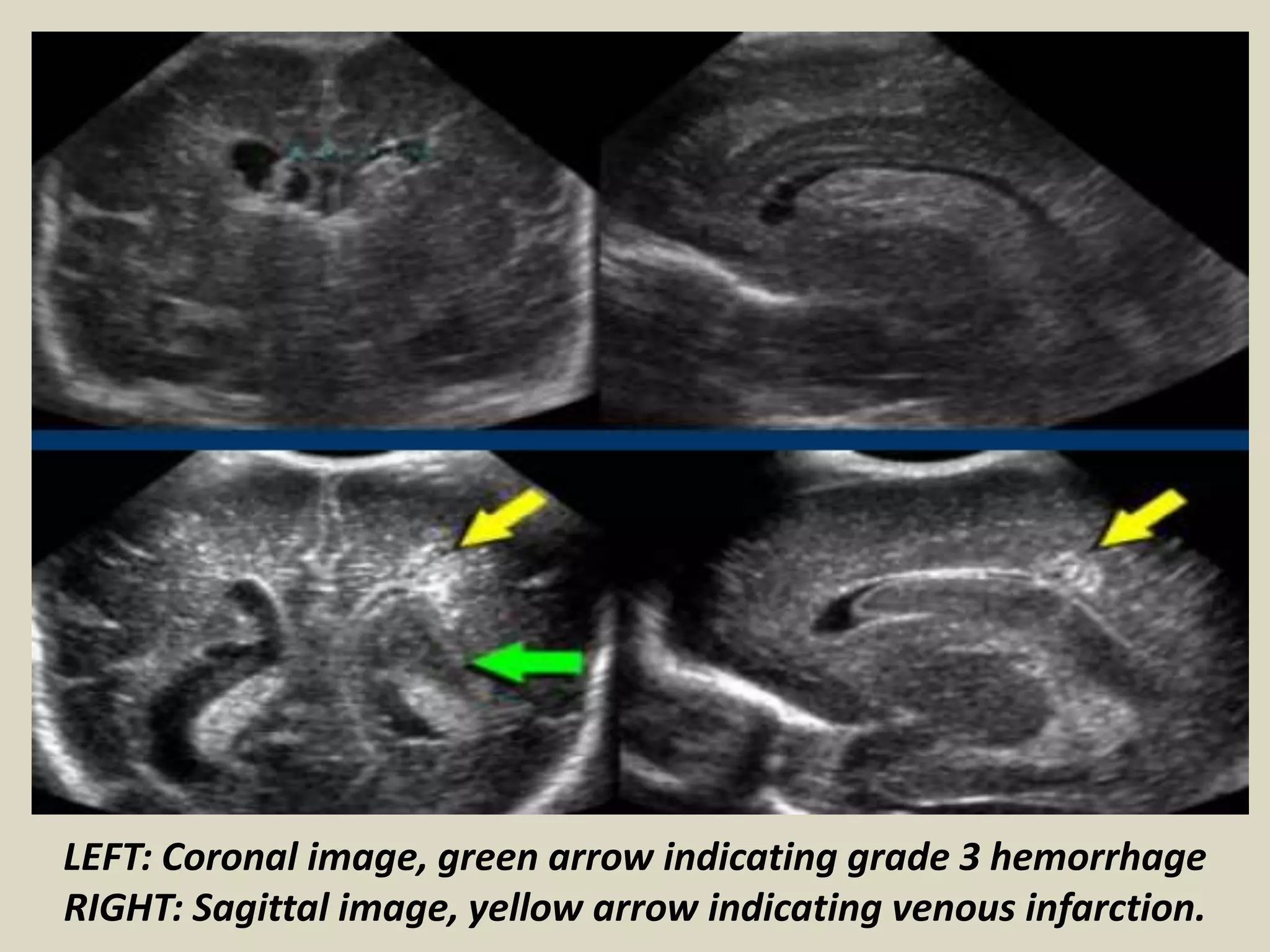 Presentation1.pptx, ultrasound examination of the neonatal head. | PPTX