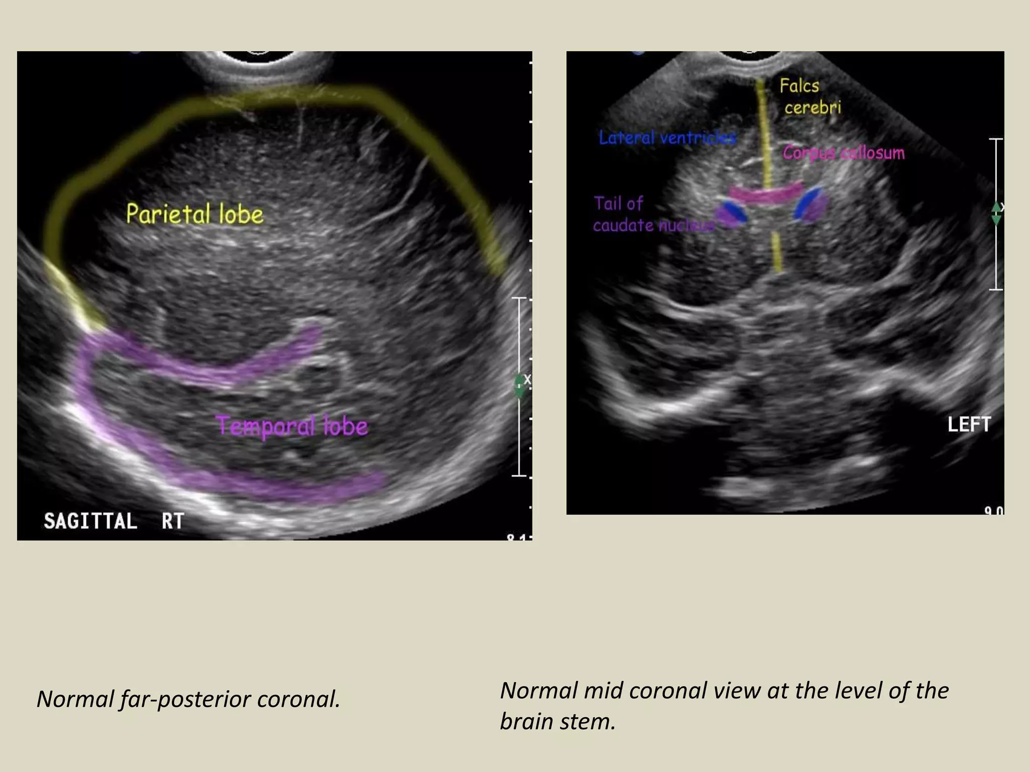 Presentation1.pptx, ultrasound examination of the neonatal head. | PPTX