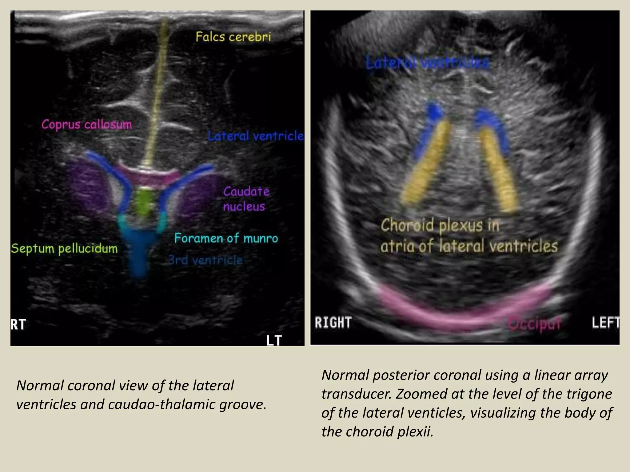 Presentation1.pptx, ultrasound examination of the neonatal head. | PPTX