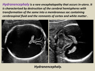 Presentation1.pptx, ultrasound examination of the neonatal head. | PPTX