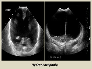 Hydranencephaly Ultrasound