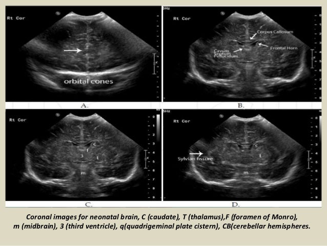 Caudate Nucleus Coronal