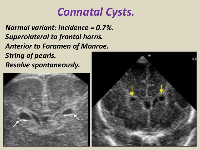 Presentation1.pptx, ultrasound examination of the neonatal head.