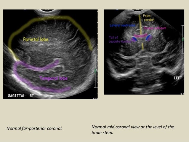 Presentation1.pptx, ultrasound examination of the neonatal head.