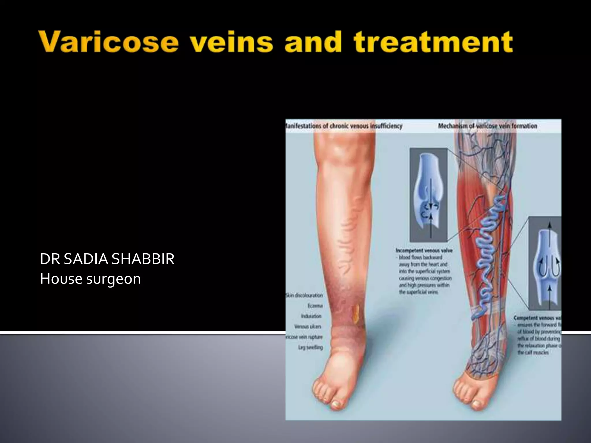 vericose veins | PPTX