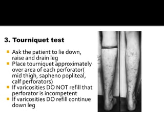 vericose veins | PPT