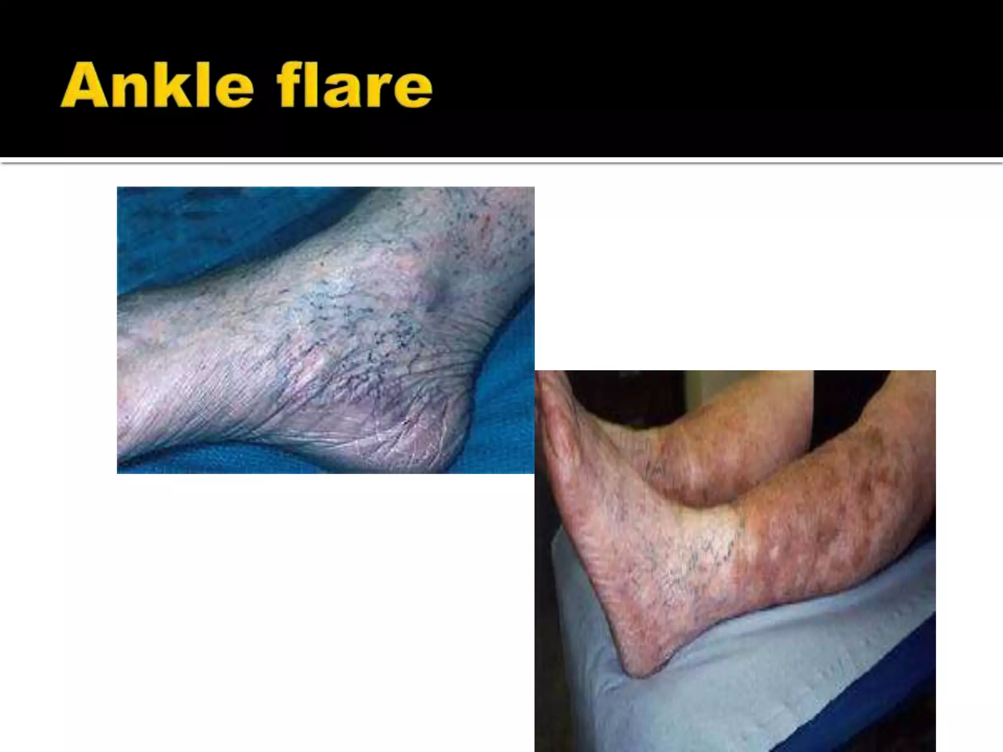 Varicose vein [ chronic venous incompetent.pptx | Free Download