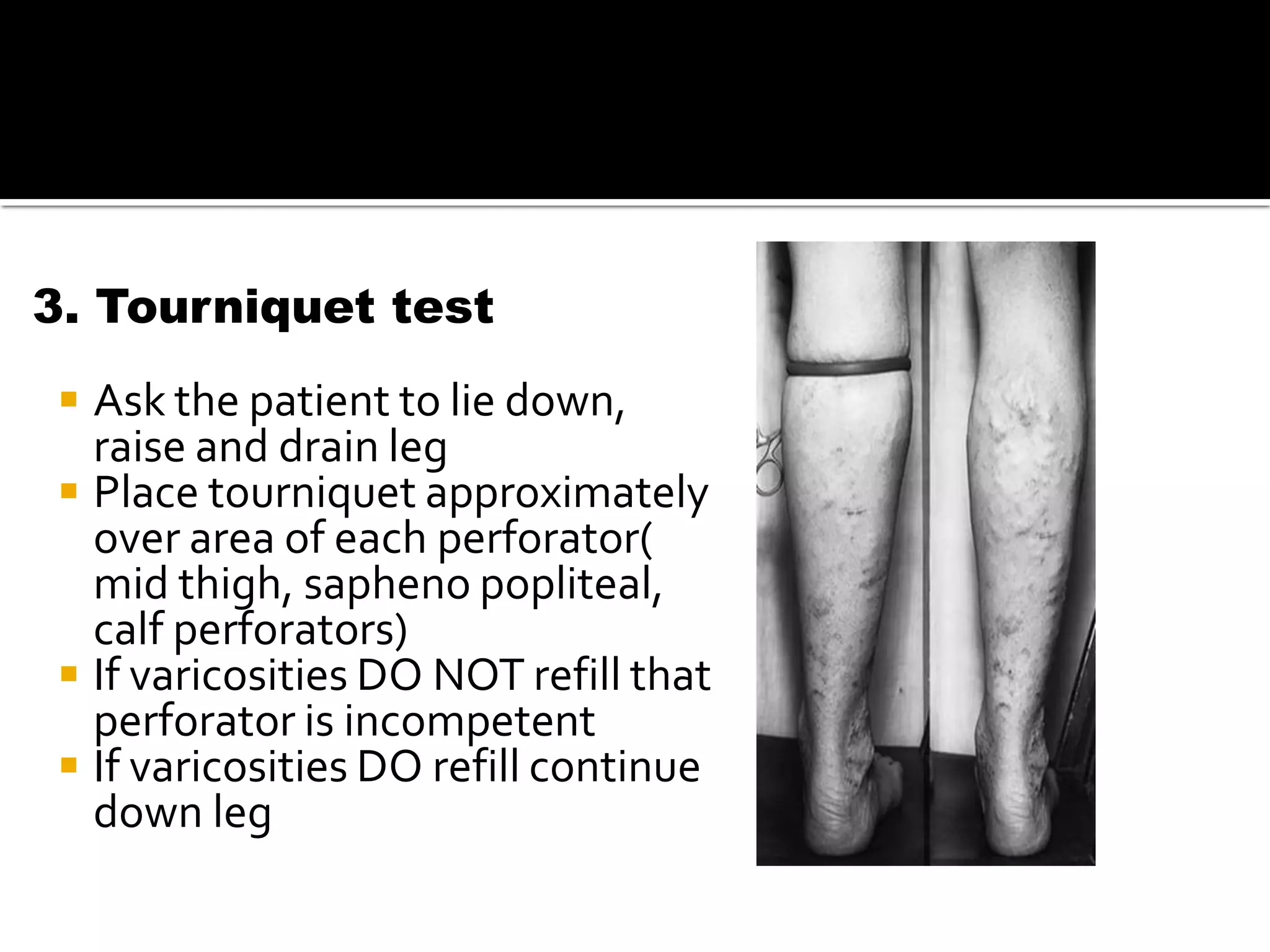 Varicose vein [ chronic venous incompetent.pptx | Free Download
