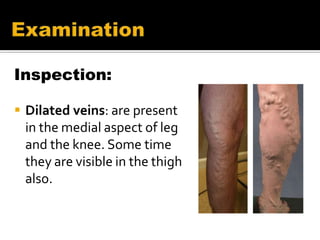 Varicose vein [ chronic venous incompetent.pptx