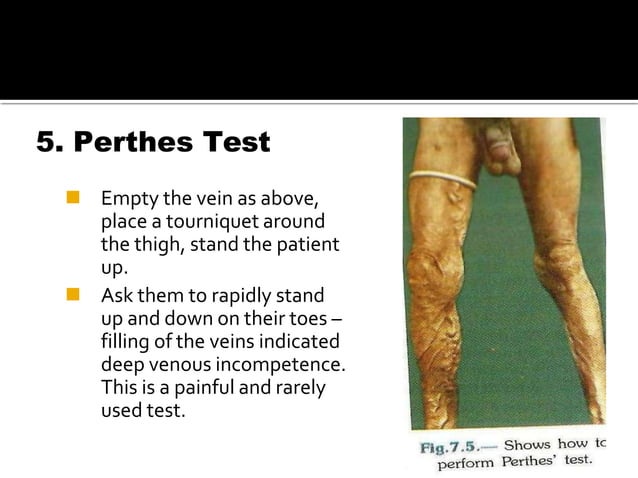 Varicose vein [ chronic venous incompetent.pptx