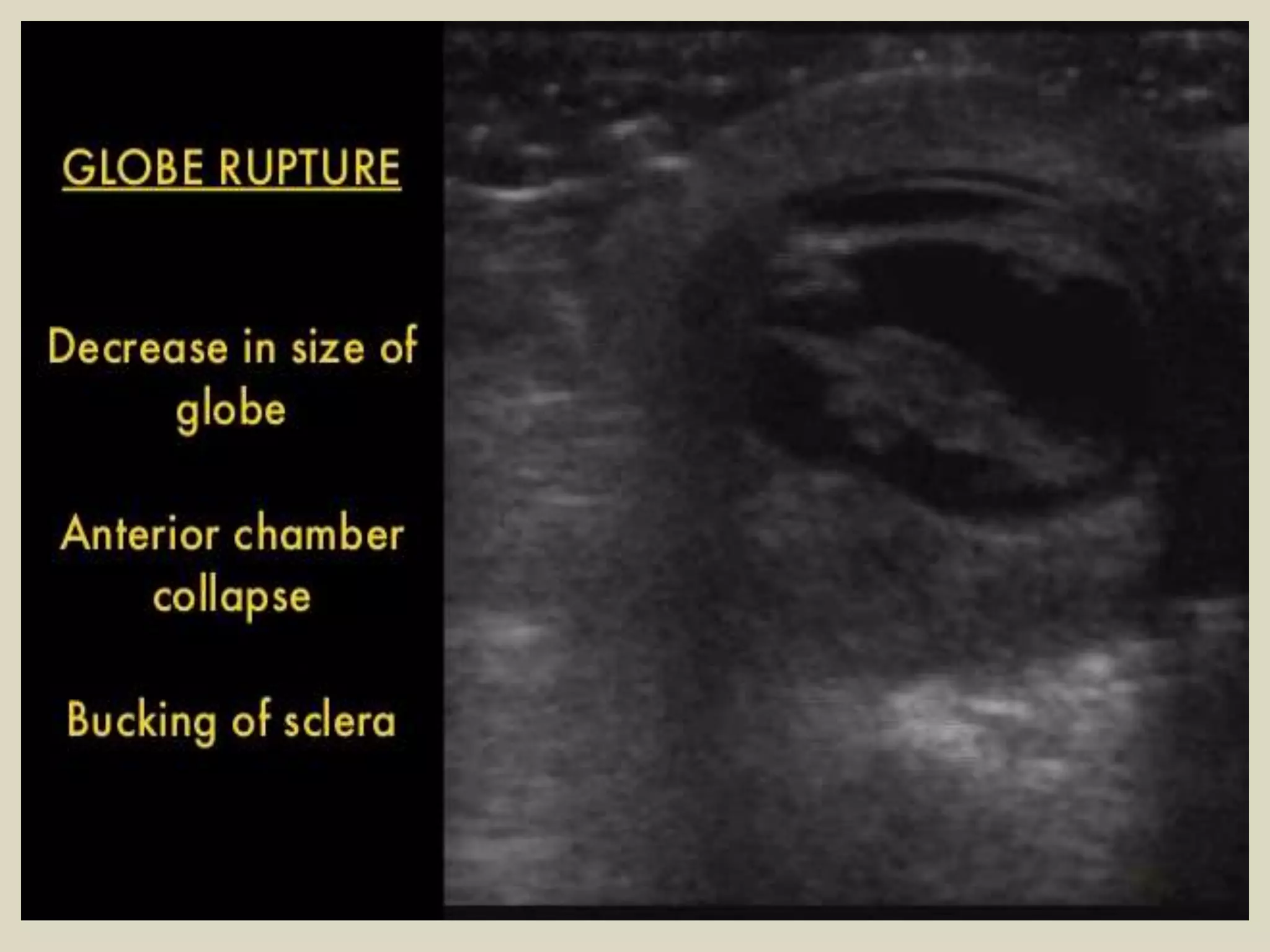Presentation1.pptx, ultrasound examination of the orbit. | PPTX
