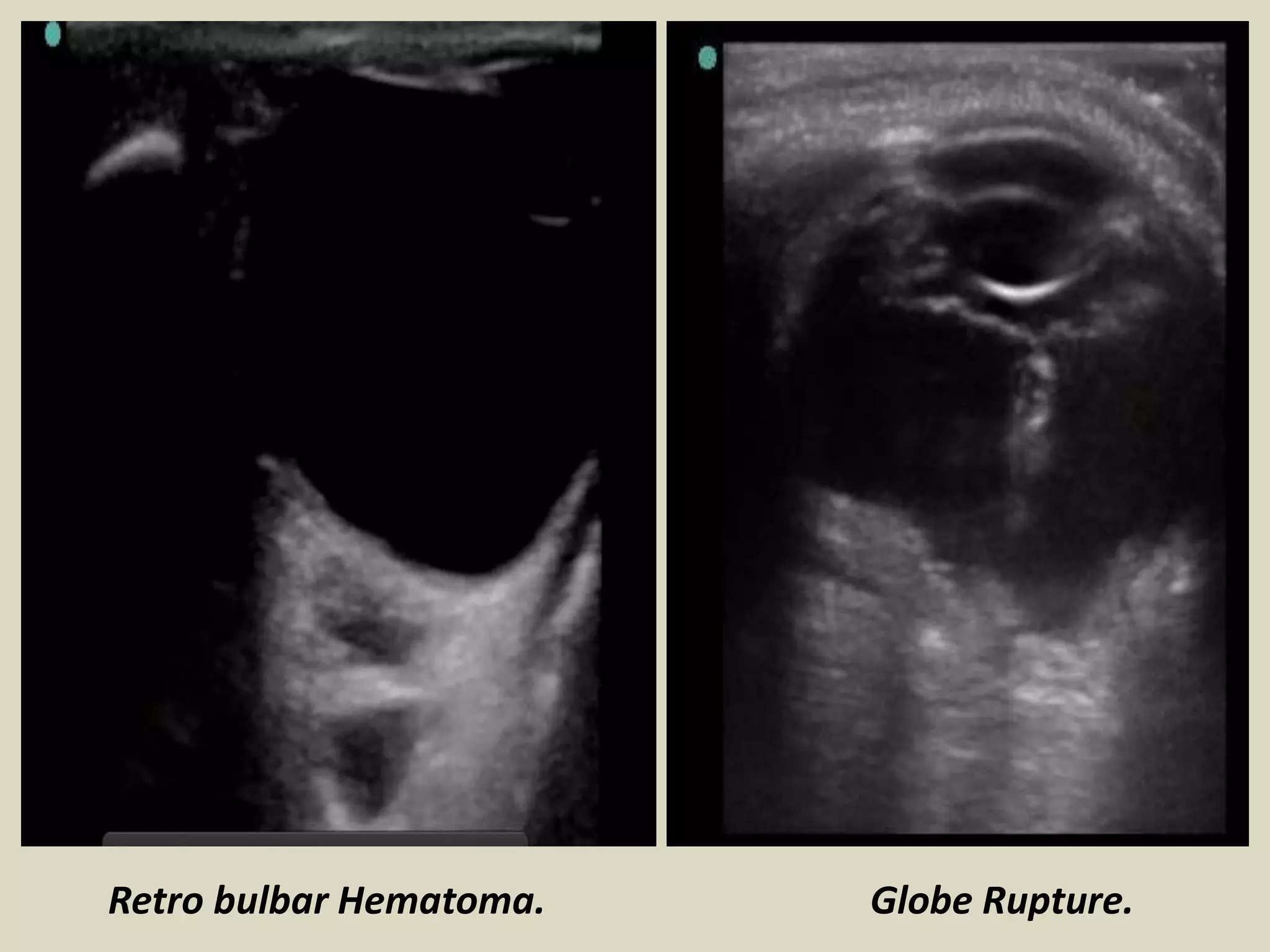 Presentation1.pptx, ultrasound examination of the orbit. | PPTX