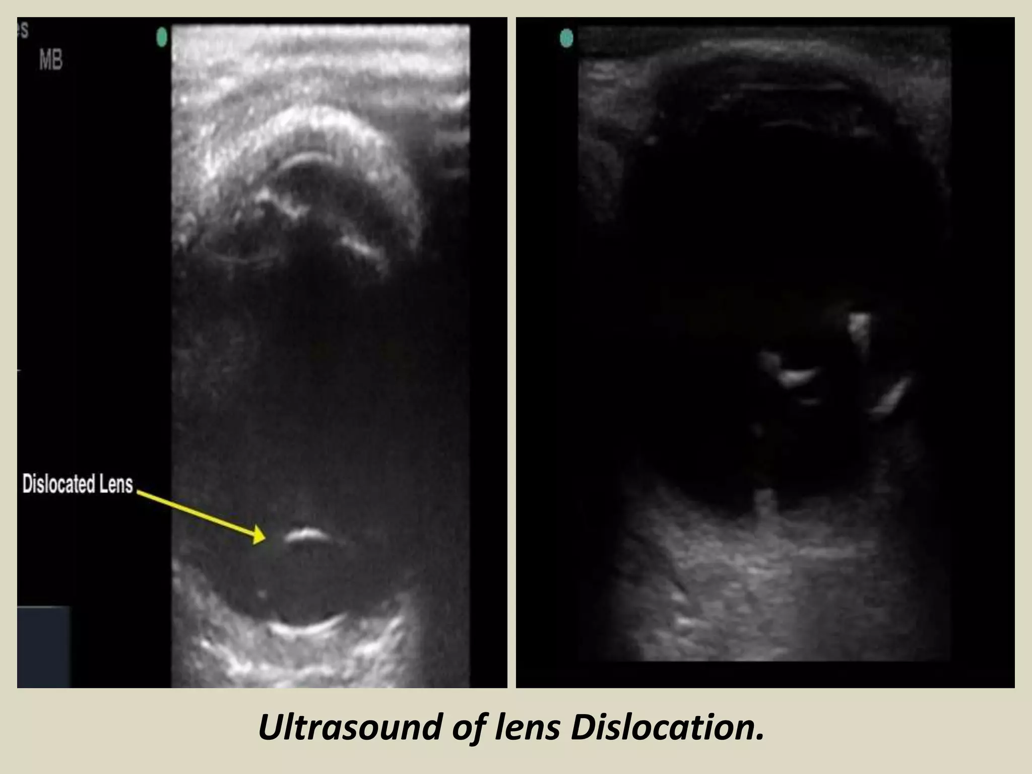 Presentation1.pptx, ultrasound examination of the orbit. | PPTX