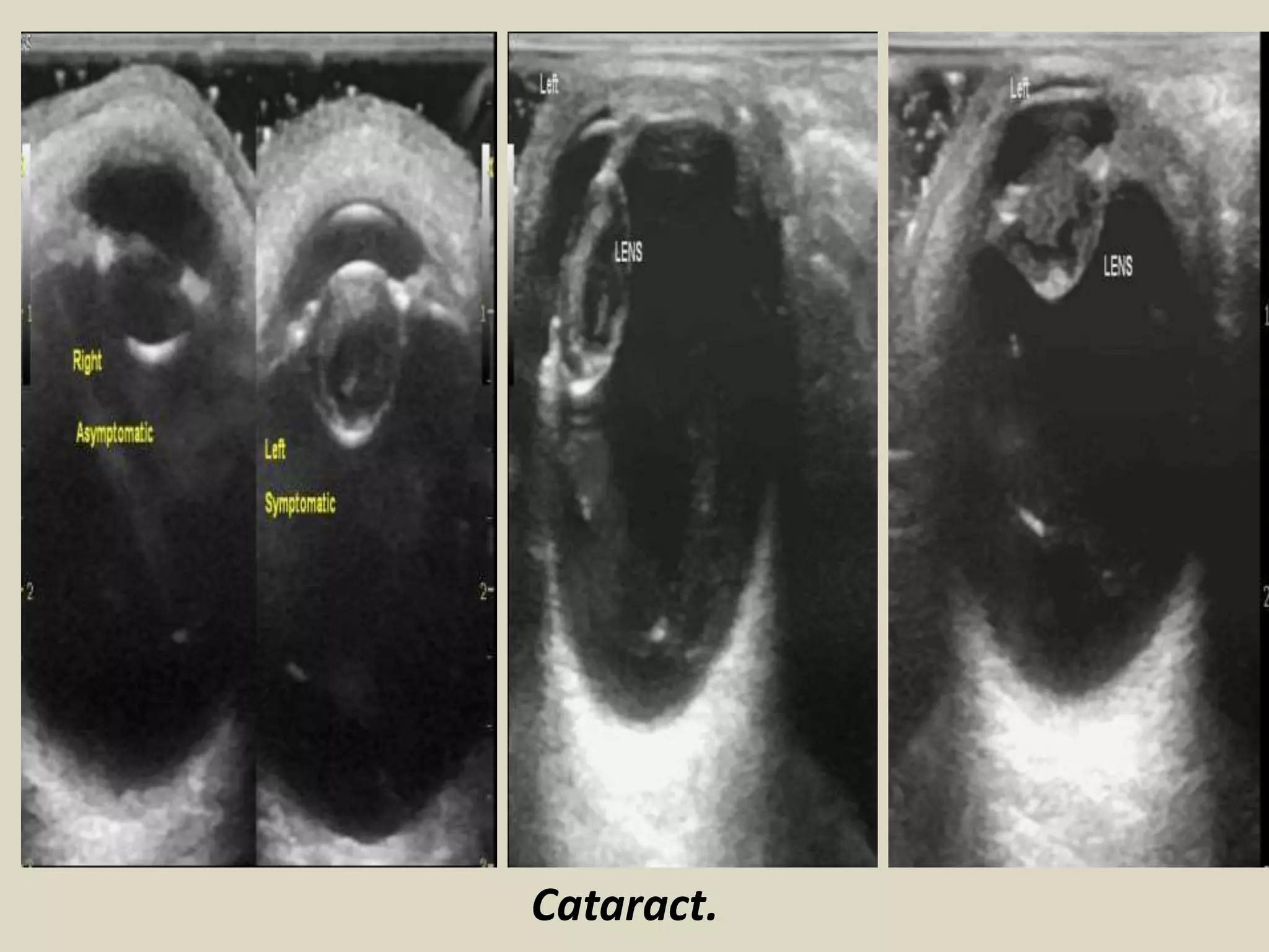 Presentation1.pptx, ultrasound examination of the orbit. | PPTX