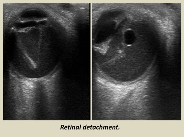 Presentation1.pptx, ultrasound examination of the orbit. | PPTX | Eye ...