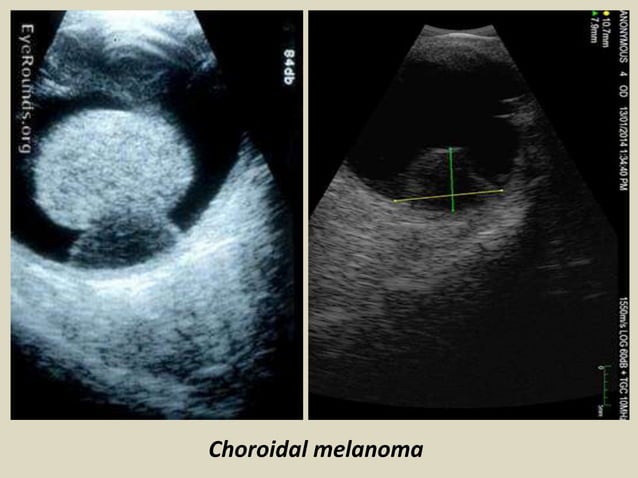 Presentation1.pptx, ultrasound examination of the orbit. | PPTX | Eye ...