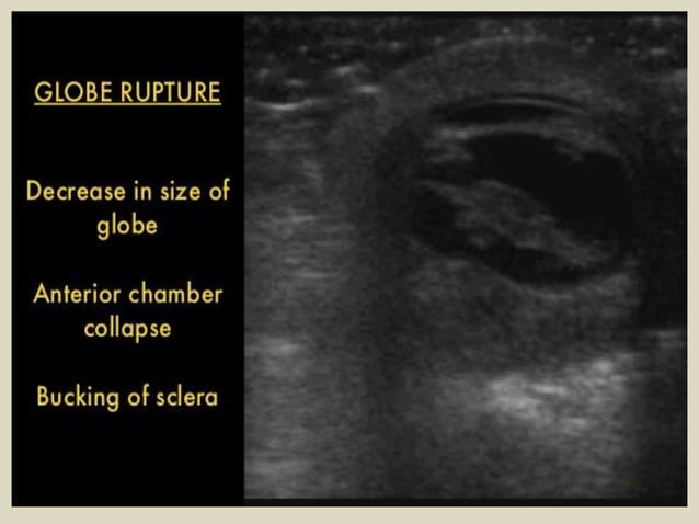 Presentation1.pptx, ultrasound examination of the orbit. | PPTX | Eye ...