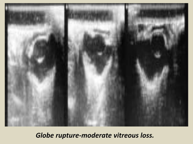 Presentation1.pptx, ultrasound examination of the orbit. | PPTX | Eye ...