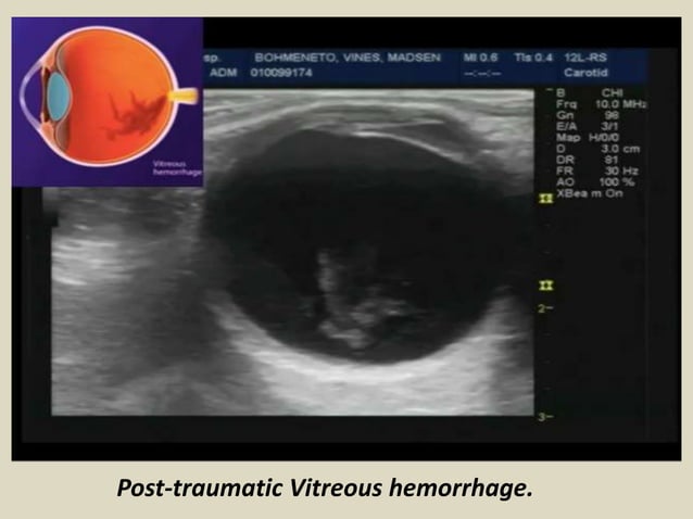 Presentation1.pptx, ultrasound examination of the orbit. | PPTX | Eye ...