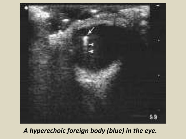 Presentation1.pptx, ultrasound examination of the orbit. | PPTX | Eye ...