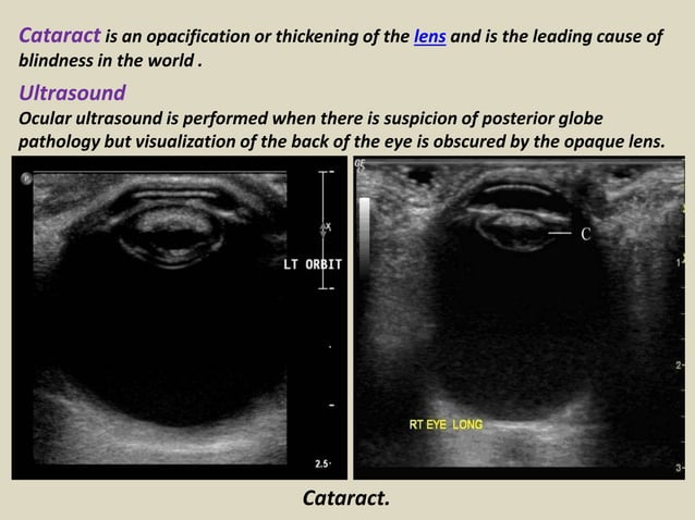 Presentation1.pptx, ultrasound examination of the orbit. | PPTX | Eye ...