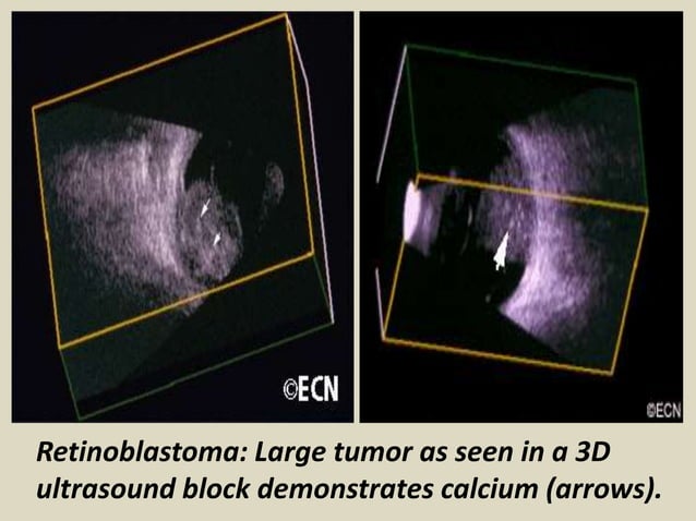 Presentation1.pptx, ultrasound examination of the orbit. | PPTX | Eye ...