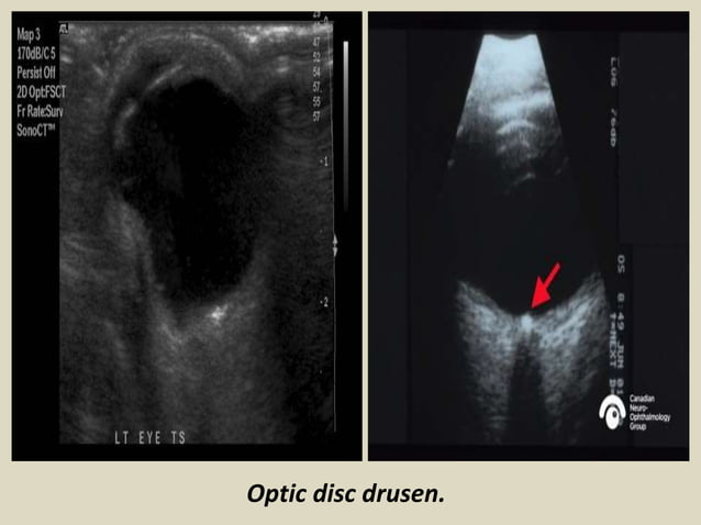 Presentation1.pptx, ultrasound examination of the orbit. | PPTX | Eye ...