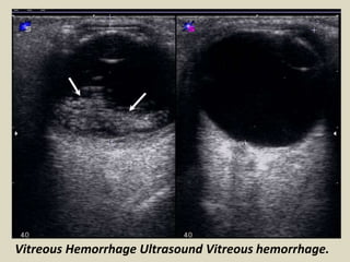 Vitreous Hemorrhage Ultrasound