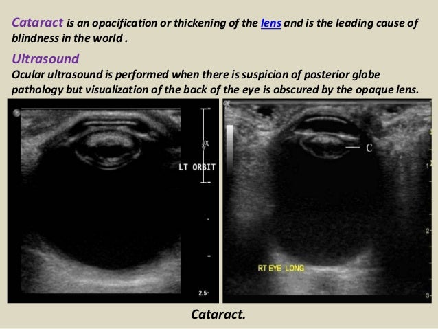 Presentation1.pptx, ultrasound examination of the orbit.