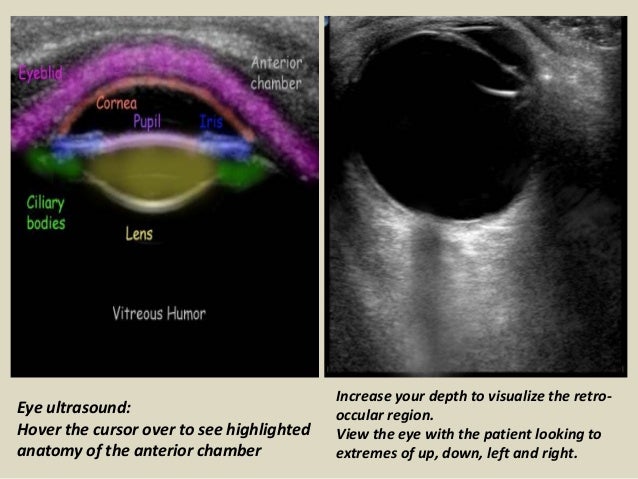 Presentation1.pptx, ultrasound examination of the orbit.