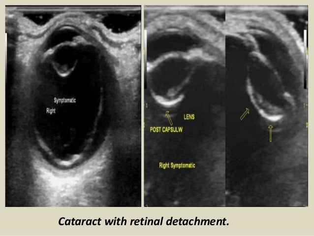 Presentation1.pptx, ultrasound examination of the orbit.