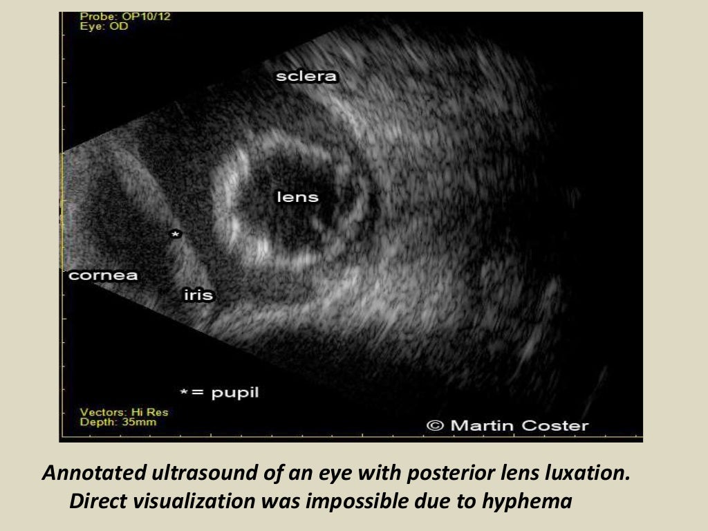 Presentation1.pptx, ultrasound examination of the orbit.