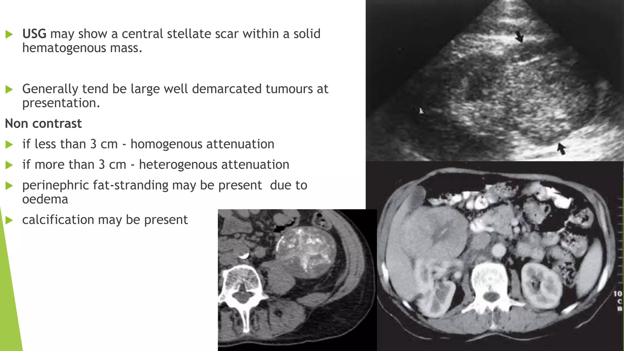 BENIGN TUMORS OF KIDNEY URETER & BLADDER | PPTX