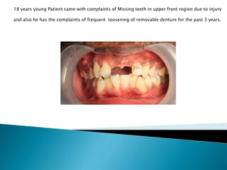 Replacing Missing Upper Front Teeth with Dental Implants in Chennai ...