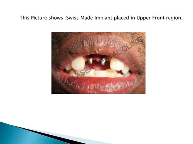 Replacing Missing Upper Front Teeth with Dental Implants in Chennai ...